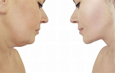 Fat Dissolvers: A Non-Surgical Solution for Stubborn Fat – EpiDermLux